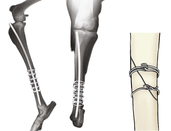 Buy fracture-and-intramedullary-pinning-with-plating Products at Best ...